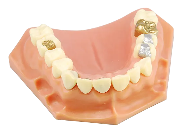Dental Inlays & Onlays - Calamvale Cosmetic Dental