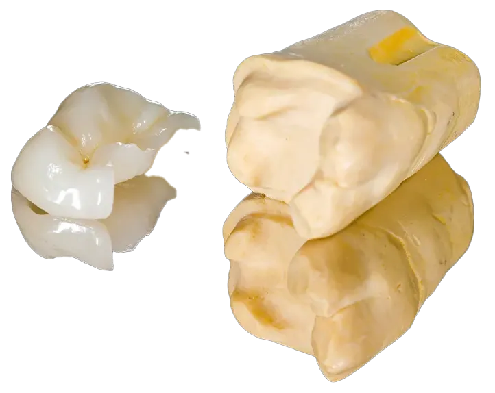 Dental Inlays & Onlays - Calamvale Cosmetic Dental